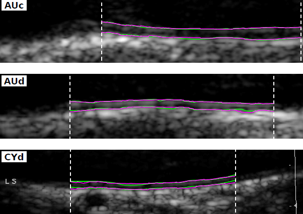 Arterial Wall Kinematics From Ultrasound Imaging Creatis